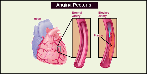 Angina Pectoris | IKHLASNYA BERBAGI