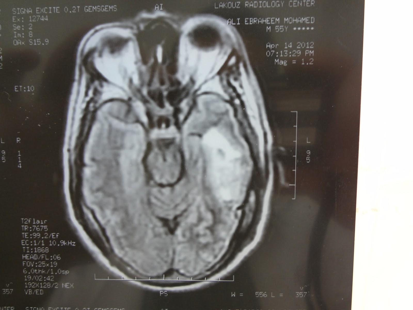 lt temporal lobe abscess complicating attico antral cholesteatoma MRI ...