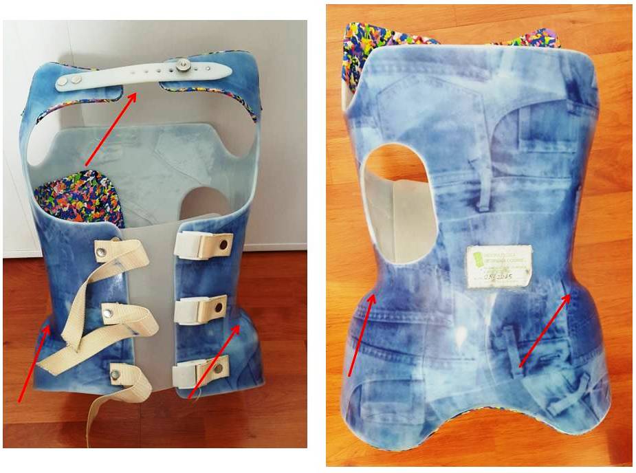 Despre corsetul Cheneau :: Corset scolioza / scoliosis braces