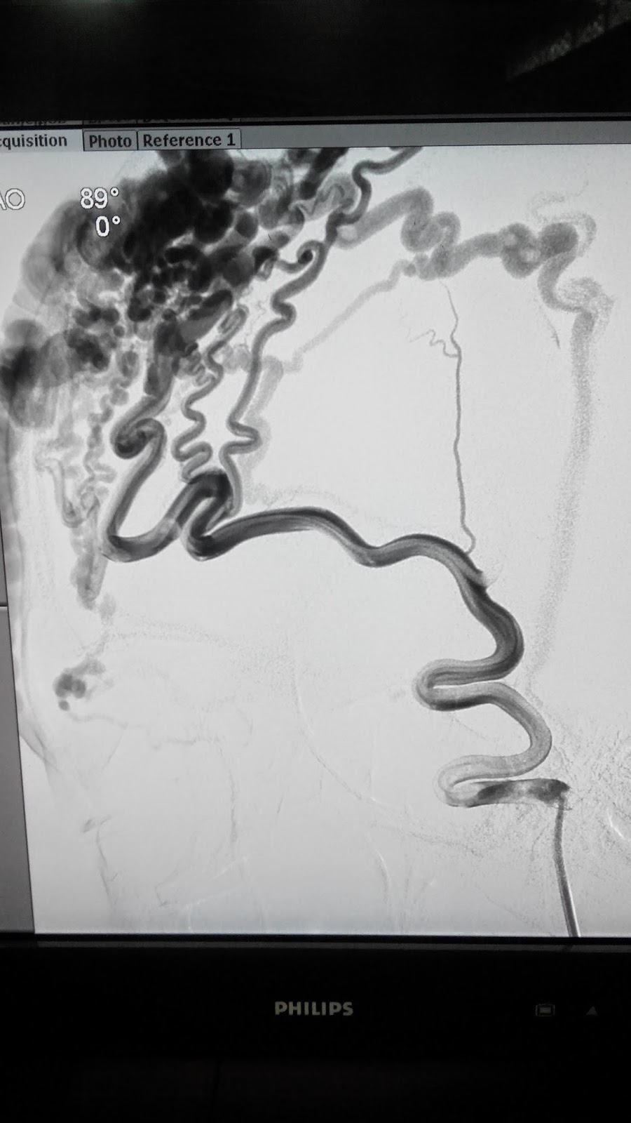 RUANG PRAKTEK BEDAH - DOKTER RAMZI SPB (K) V: Embolisasi pada AVM berat ...