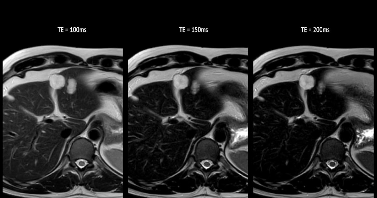Ultimate Radiology : The 'Light bulb sign' of liver hemangioma [MRI]