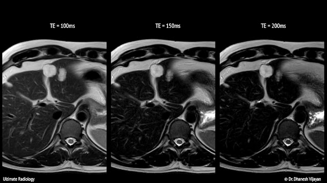Ultimate Radiology : The 'Light bulb sign' of liver hemangioma [MRI]