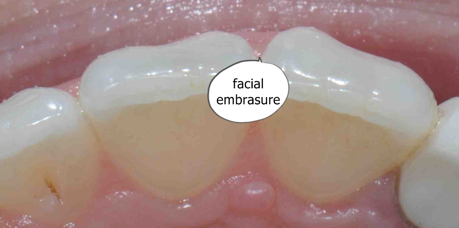 Tempat Nongkrong Koas Gigi...: Class IV Filling for The Dumbest -Part 3 ...