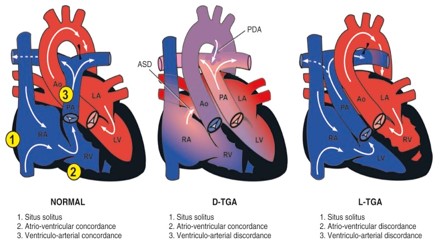 發紺性先天性心臟病 - 大動脈轉位 Transposition of great arteries, TGA