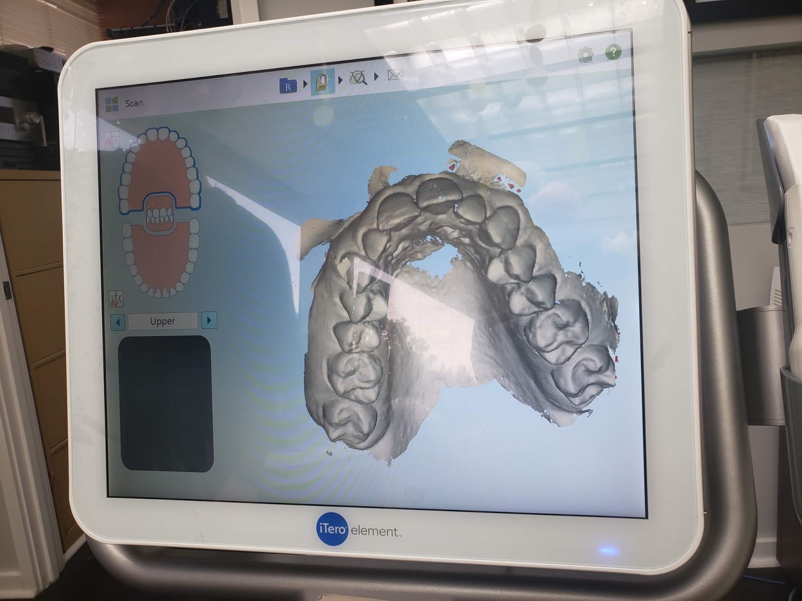 My experience with the MSE (maxillary skeletal expander): 6-12-2019 Scan
