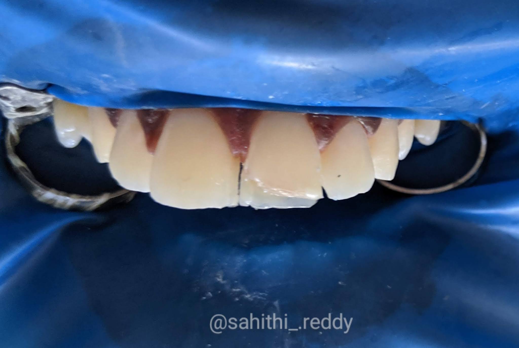 BIO-EMULATION with composite resin