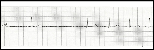 Characteristics of Sinus Rhythms