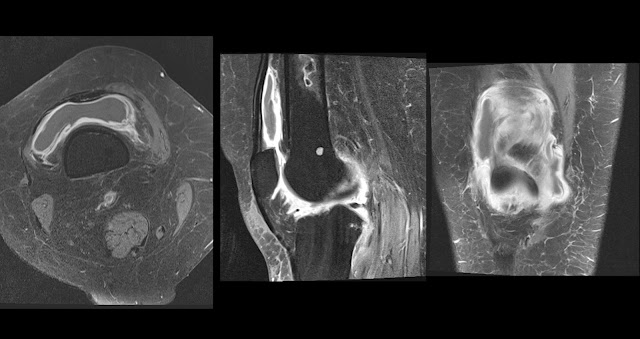 Ultimate Radiology : Synovitis with Bone Infarcts in distal femur