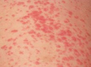 Gejala dan Pengobatan Rubella (Campak Jerman) | Medkes