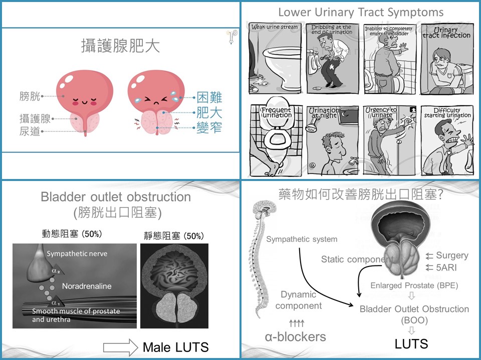 新莊高美泌尿科診所 ‧ 許家豪院長 ‧ 果石的泌密: 2020/12/02 神經內科晨會演講: 好好放鬆攝護腺，超高專一性的Silodosin ...