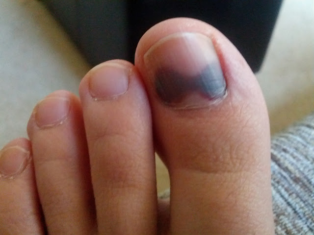 Ongles noirs : comment les traiter