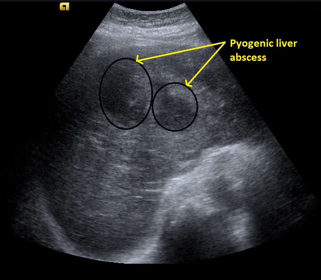 MEDICAL ULTRASOUND/ HEPATIC ABSCESS