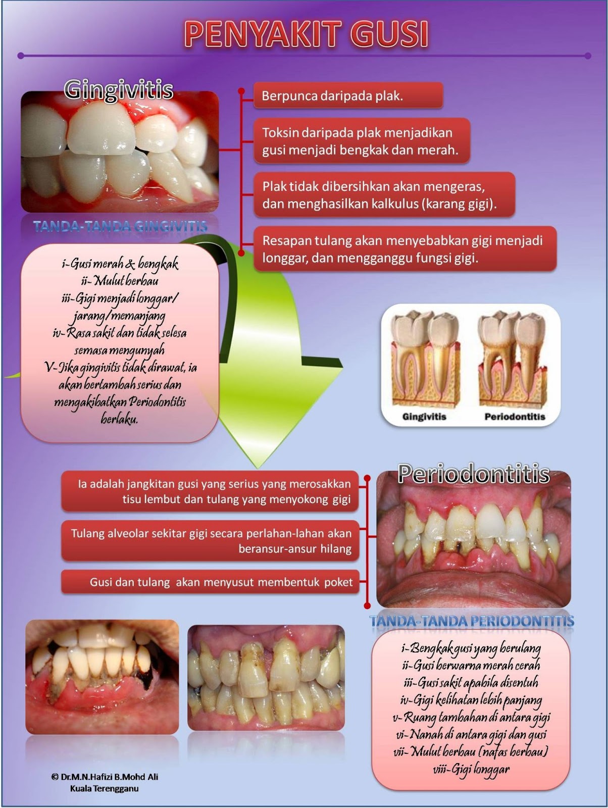 Healthy Mouth For All: Penyakit Gusi (Part 1)