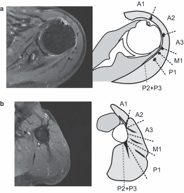 Shoulder / ПЛЕЧИ: Anatomical and functional segments of the deltoid muscle