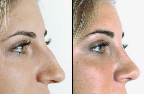 Perfect Nose Nose Straightener Review