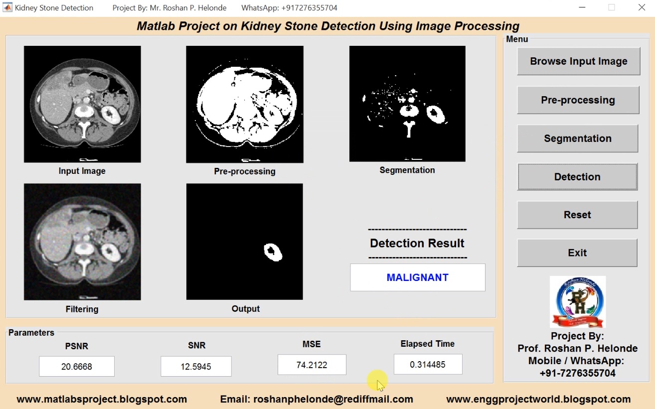 Kidney Stone Detection Using Matlab Source Code ~ ENGINEERING PROJECTS