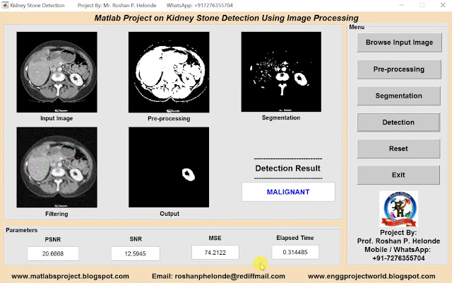 Kidney Stone Detection Using Matlab Source Code ~ ENGINEERING PROJECTS