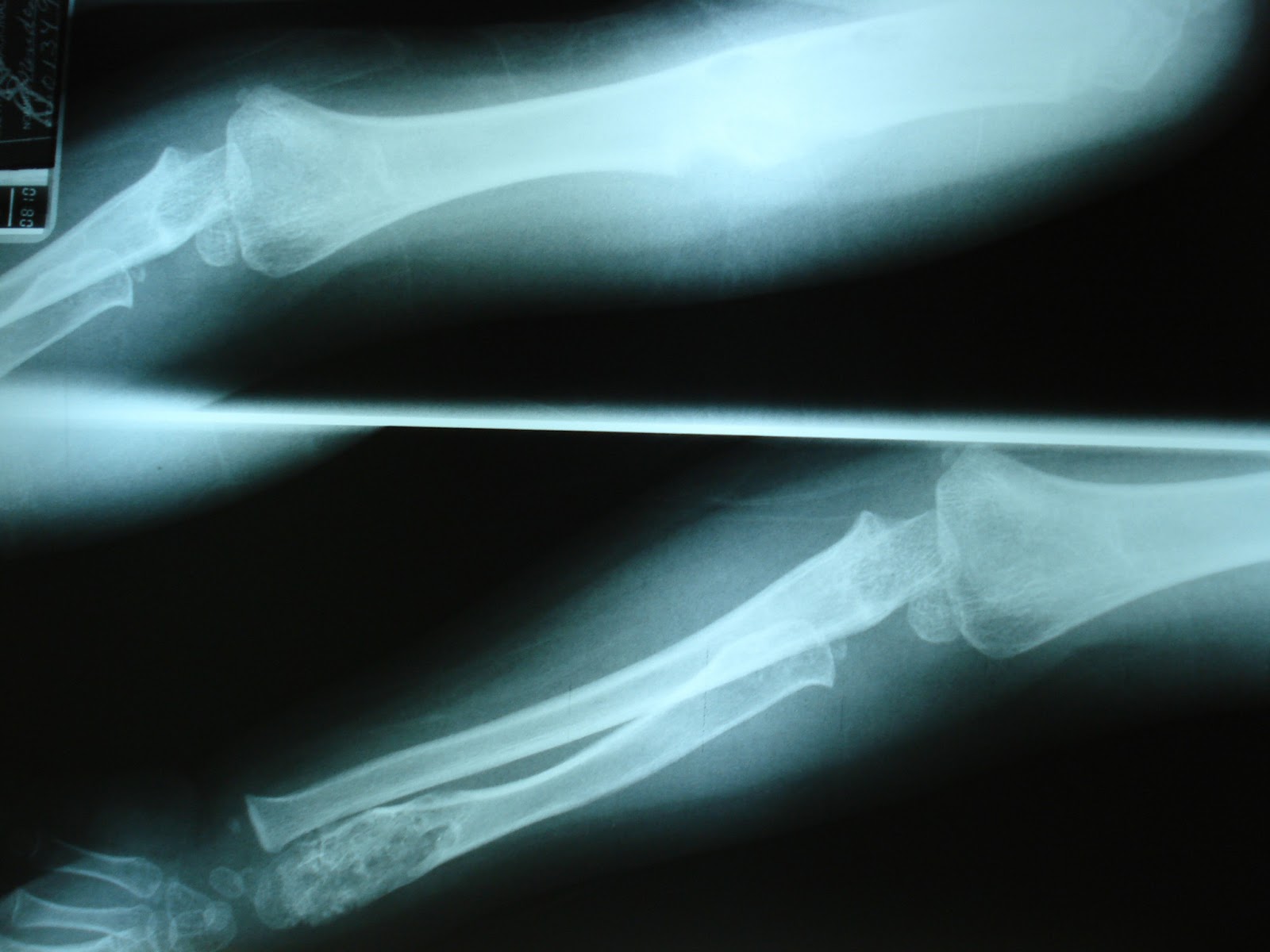 Ortopedia_Oncologica_Mexico: Encondromatosis múltiple, de la serie: Un ...
