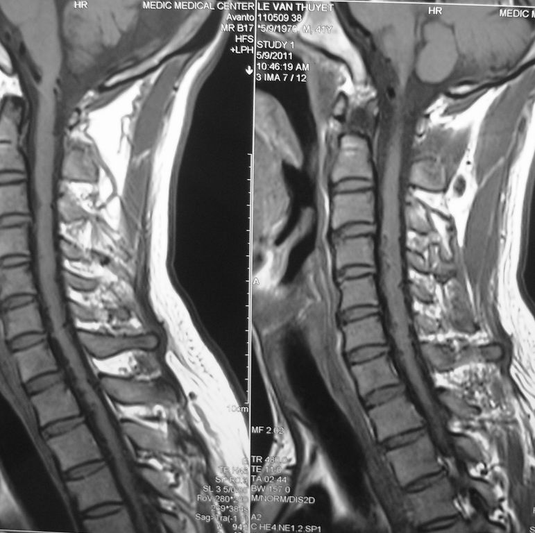 MRI MEDIC CASE STUDIES COLLECTION: SPINAL AVM