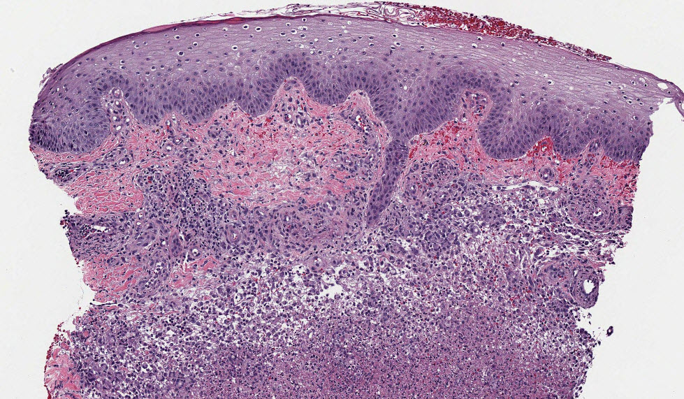 Differential Diagnosis in Dermatopathology: Thickened epidermis