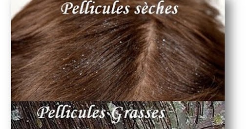 Pellicules des cheveux ~ Nos Conseils de Vie