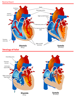 Pathophysiology of Tetralogy of Fallot - Nanda Care Plan