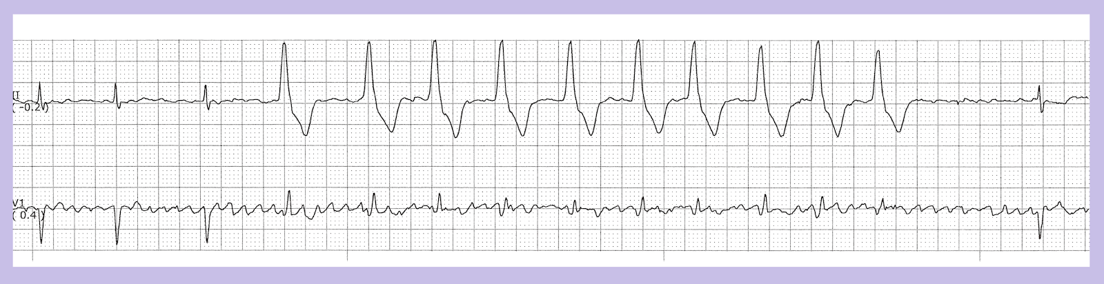 Float Nurse: Practice EKG Strips 332