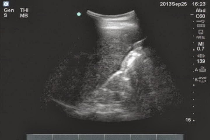 VIETNAMESE MEDIC ULTRASOUND: CASE 210: LEFT ABDOMINAL MASS, Dr PHAN ...