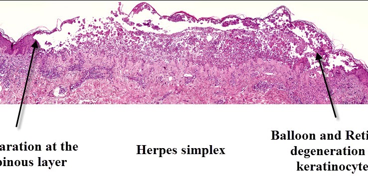 Dermatopathology Made Simple - Inflammatory: Pustular Reaction Pattern