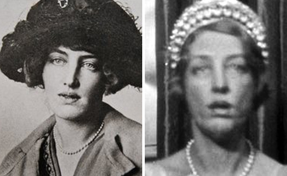 Eyelid Surgery by Prof Dr CN CHUA 蔡鐘能: Complications of Tear Trough ...