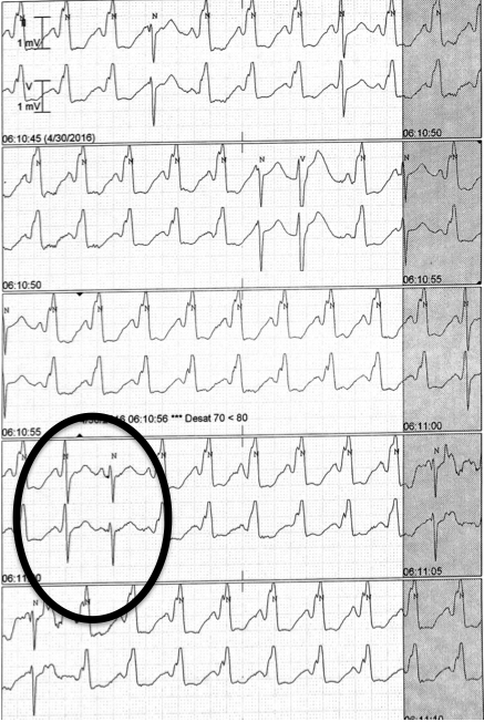 Dr. Smith's ECG Blog: Wide Complex Tachycardia with Fusion and Capture ...