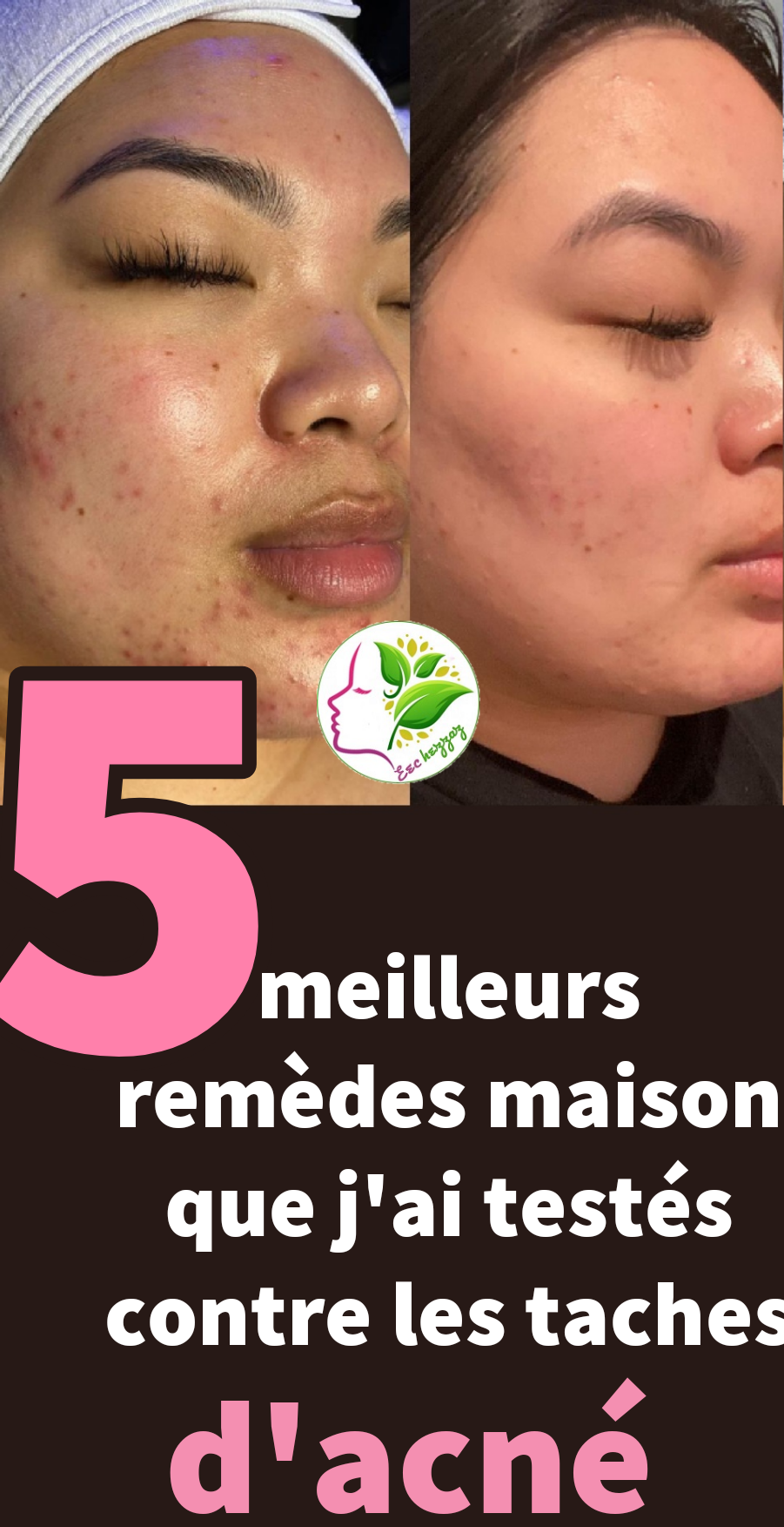 5 meilleurs remèdes maison que j'ai testés contre les taches d'acné