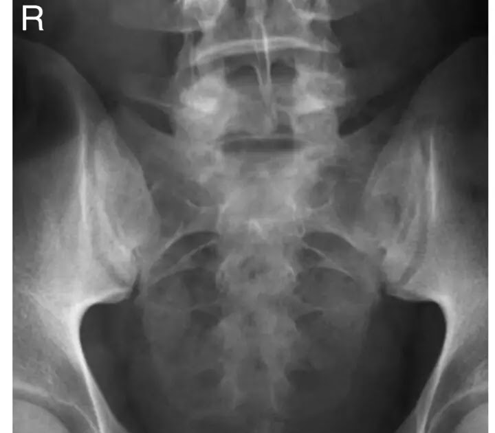 Sacrum AP/PA x-ray in hindi - paramedical guru