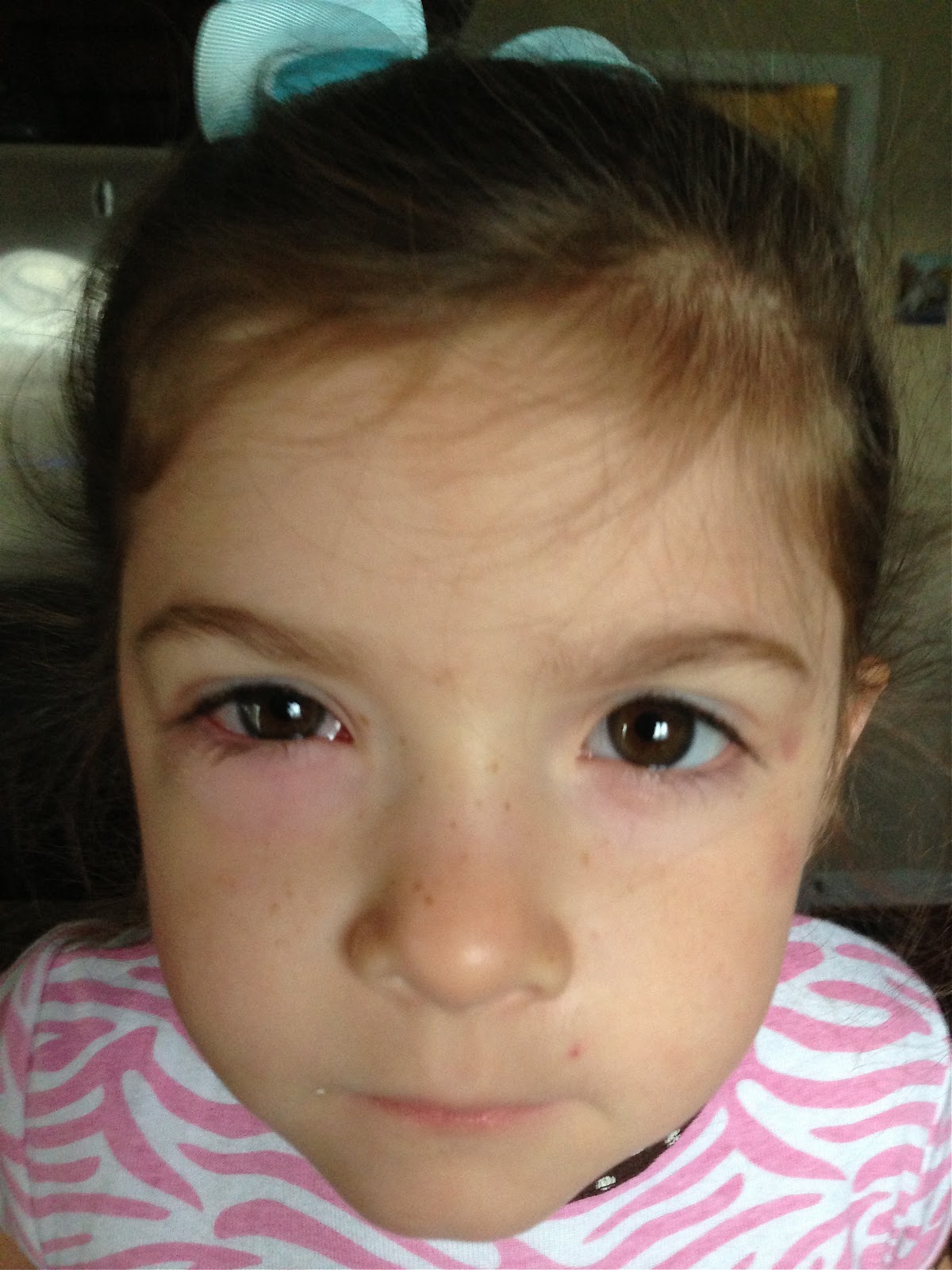 Worst Case Of Pink Eye