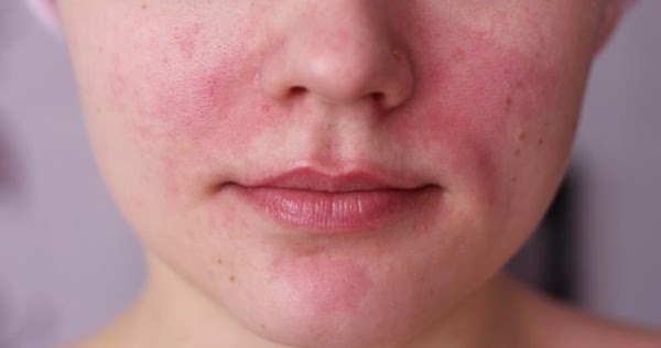 What Is Rosacea On The Face And How To Get Rid Of It? - Mouthwash Guide ...