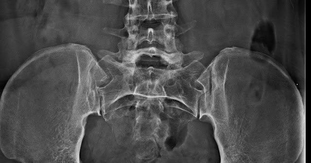 Ultimate Radiology : Inverted Napoleon Hat Sign