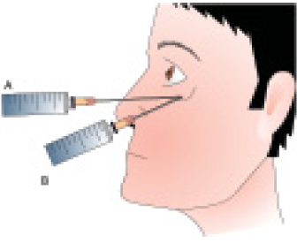 What is Retrobulbar Block