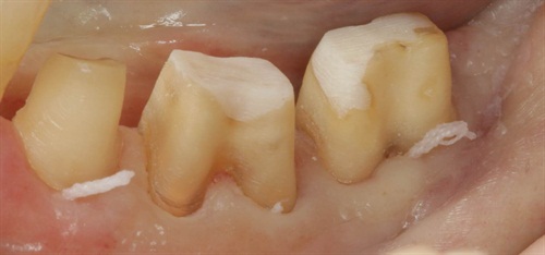 Biological shaping and barrel flute of crown - Bauer Smiles