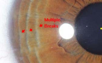 Modern & Multidimensional Iridology: Sectoral Opening - Multiple Breaks ...