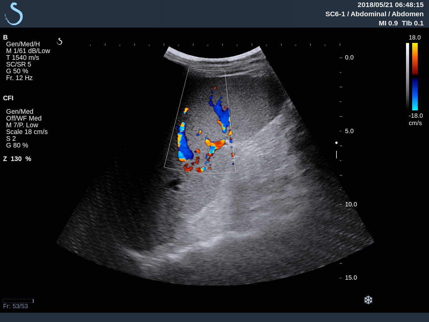 VIETNAMESE MEDIC ULTRASOUND: CASE 494: PRIMARY LIVER LYMPHOMA (PLL),Dr ...