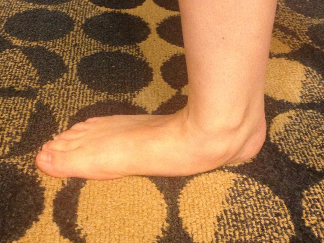 The Road to Two Normal Feet