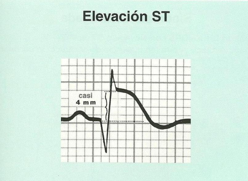 Dr. Rafael Soto - Electrocardiografía - Cardiología clínica: Infarto ...