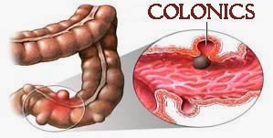 Altered Tapestry: Colonics: Key To Better Health And Fit Body