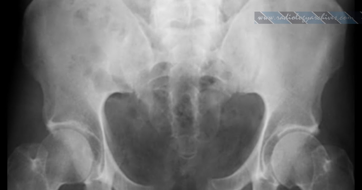 Radiology Archives: Κάταγμα Λεκάνης (Πυελικού Δακτυλίου) (κατα Tile B1 ...