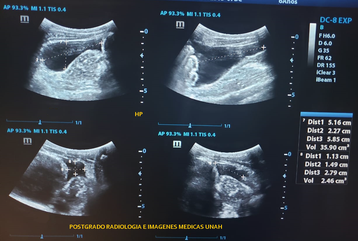 Poliserositis por Dengue.