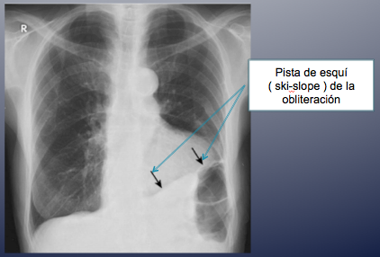 IDENTIFICACIÓN DE UN DERRAME PLEURAL: Cicatrización con obliteración ...