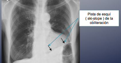 IDENTIFICACIÓN DE UN DERRAME PLEURAL: Cicatrización con obliteración ...