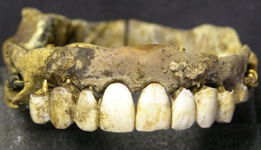 Many of the Dentures in the 18th and 19th Centuries Were Made From the ...