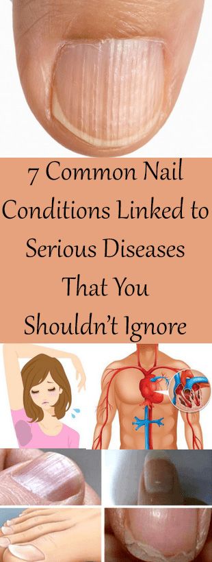 7 Common Nail Conditions Linked to Serious Diseases That You Shouldn’t ...