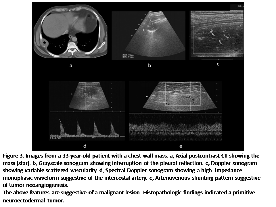 BÀI SOẠN VỀ SIÊU ÂM CHẨN ĐOÁN: CHEST WALL INVASION by LUNG TUMORS: US ...